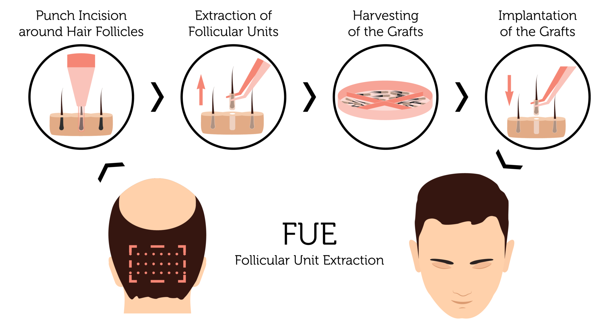 FUE (Follicular Unit Extraction) – Nirvana
